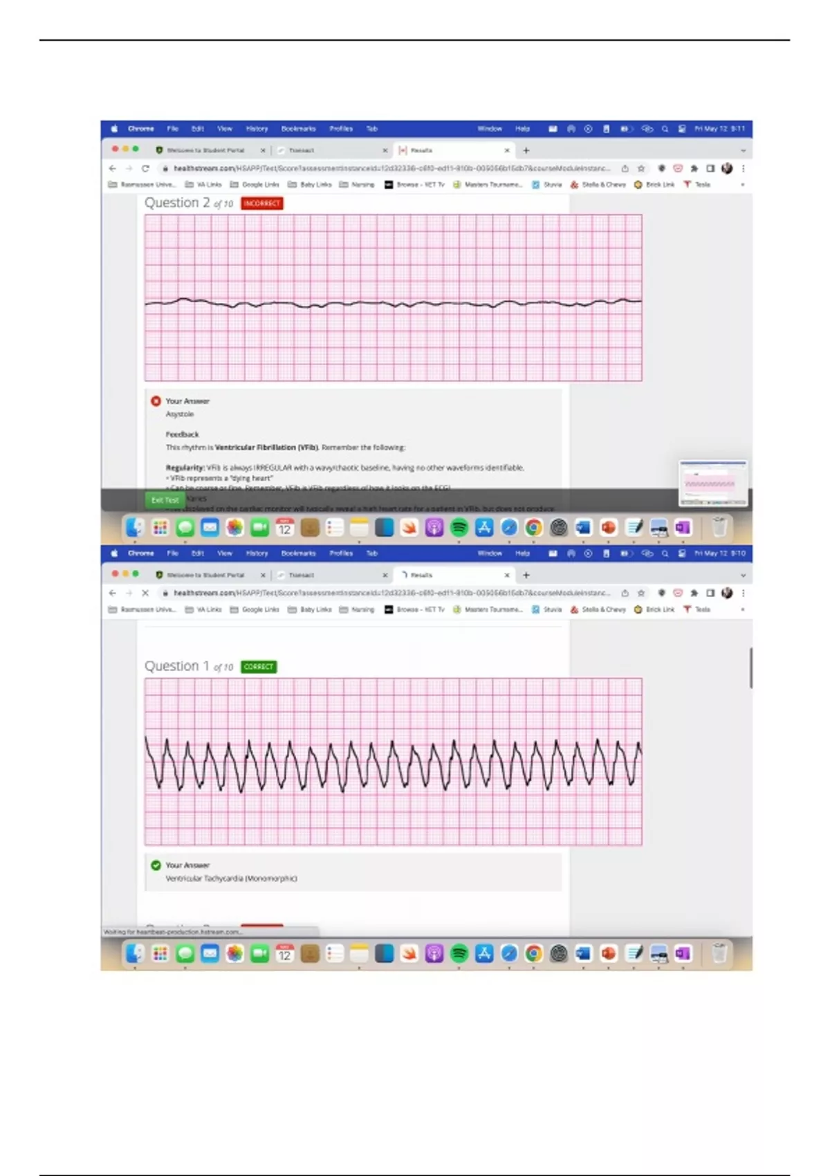 StaRN EKG Test For HCA Lethal And Non Lethal Rhythms Stuvia US StaRN EKG Test For HCA Lethal And Non Lethal Rhythms Stuvia US