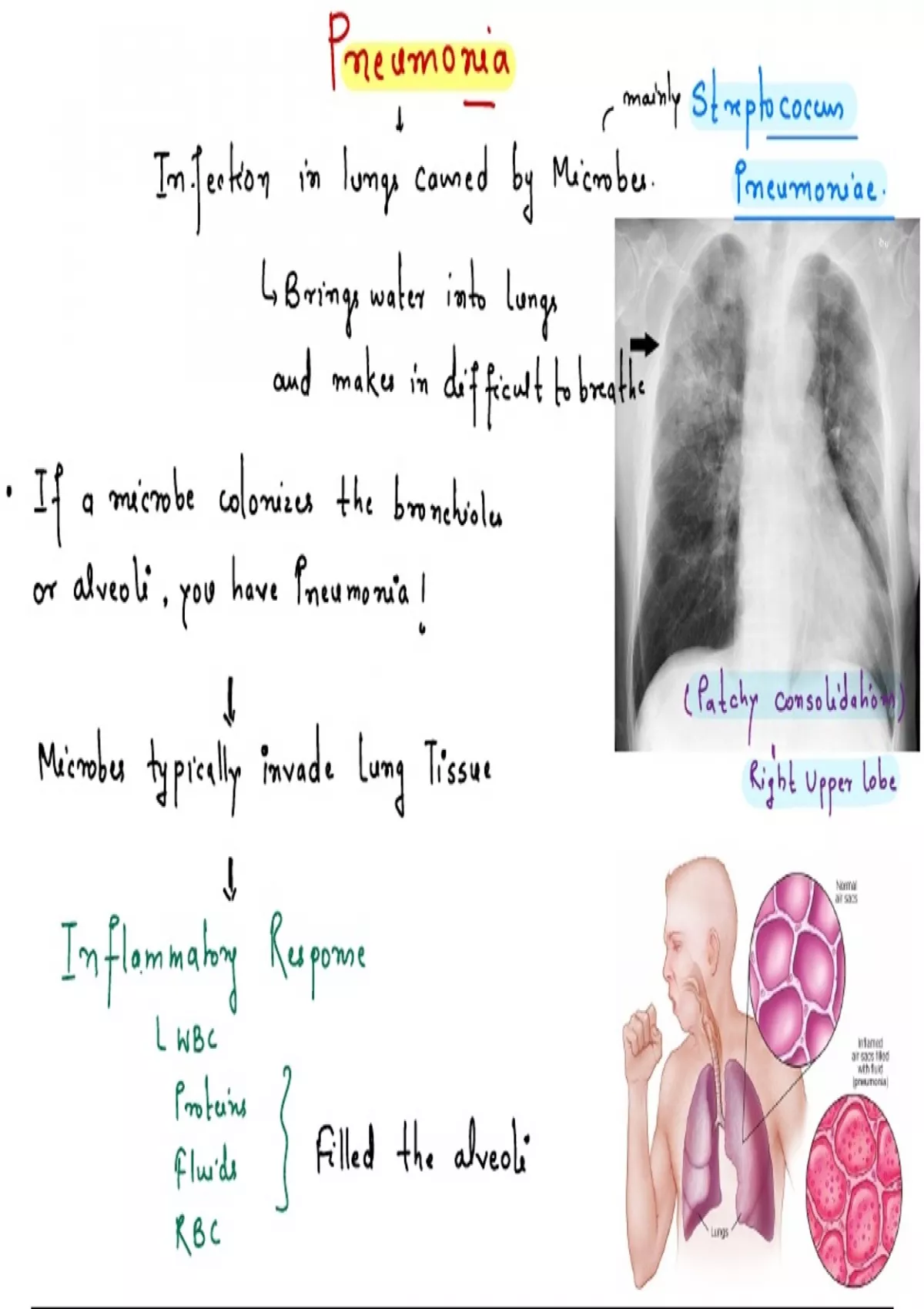 Summary Notes on Pneumonia - ATI 2023 - Stuvia US