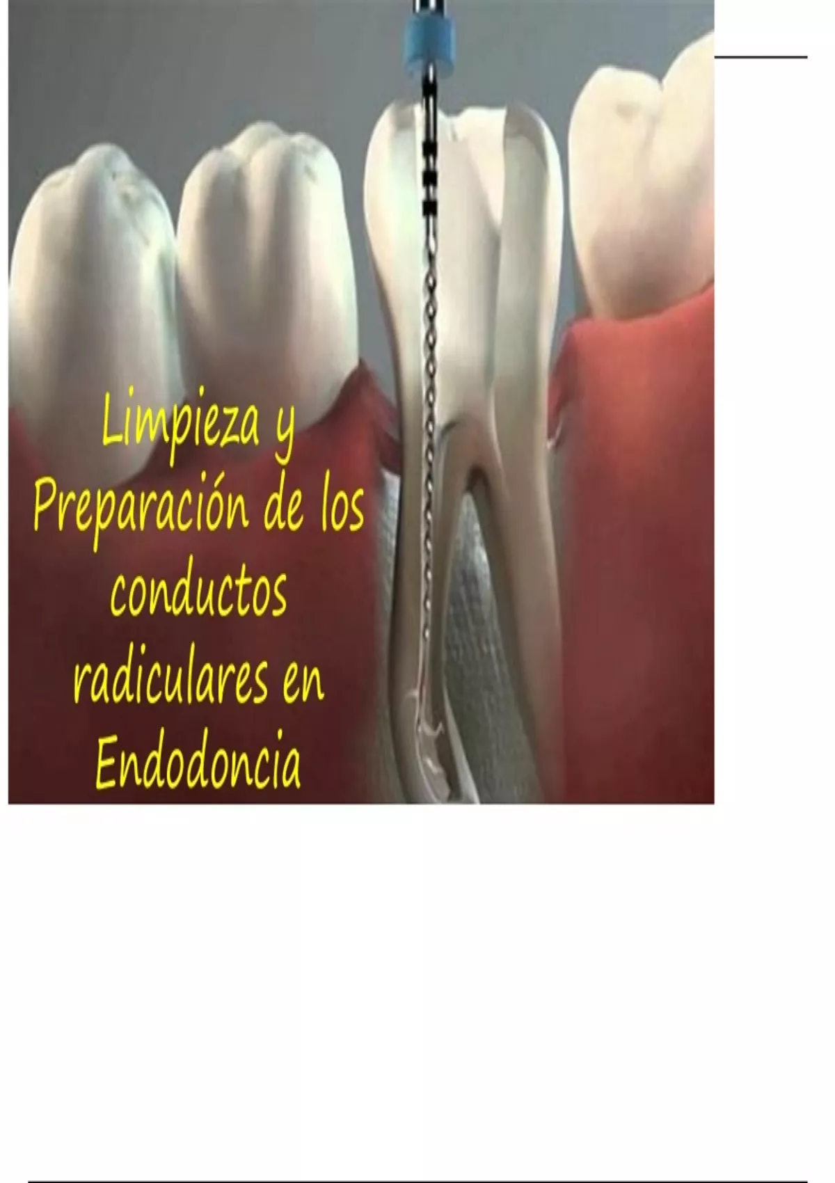 Limpieza y Preparación de los conductos radiculares en Endodoncia ...