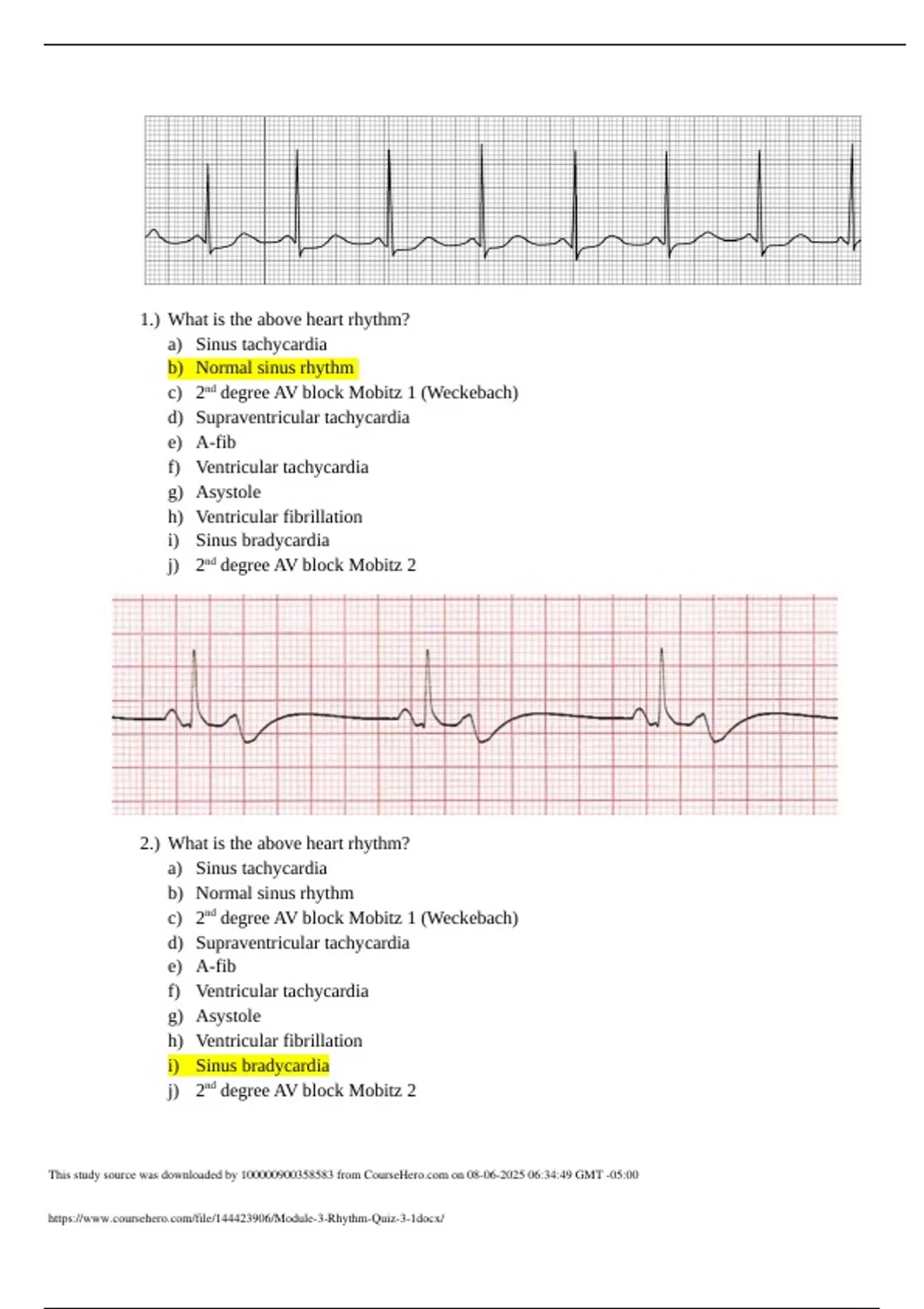 Dysrhythmia Recognition Quiz with Answers – Complete ECG Rhythm ...