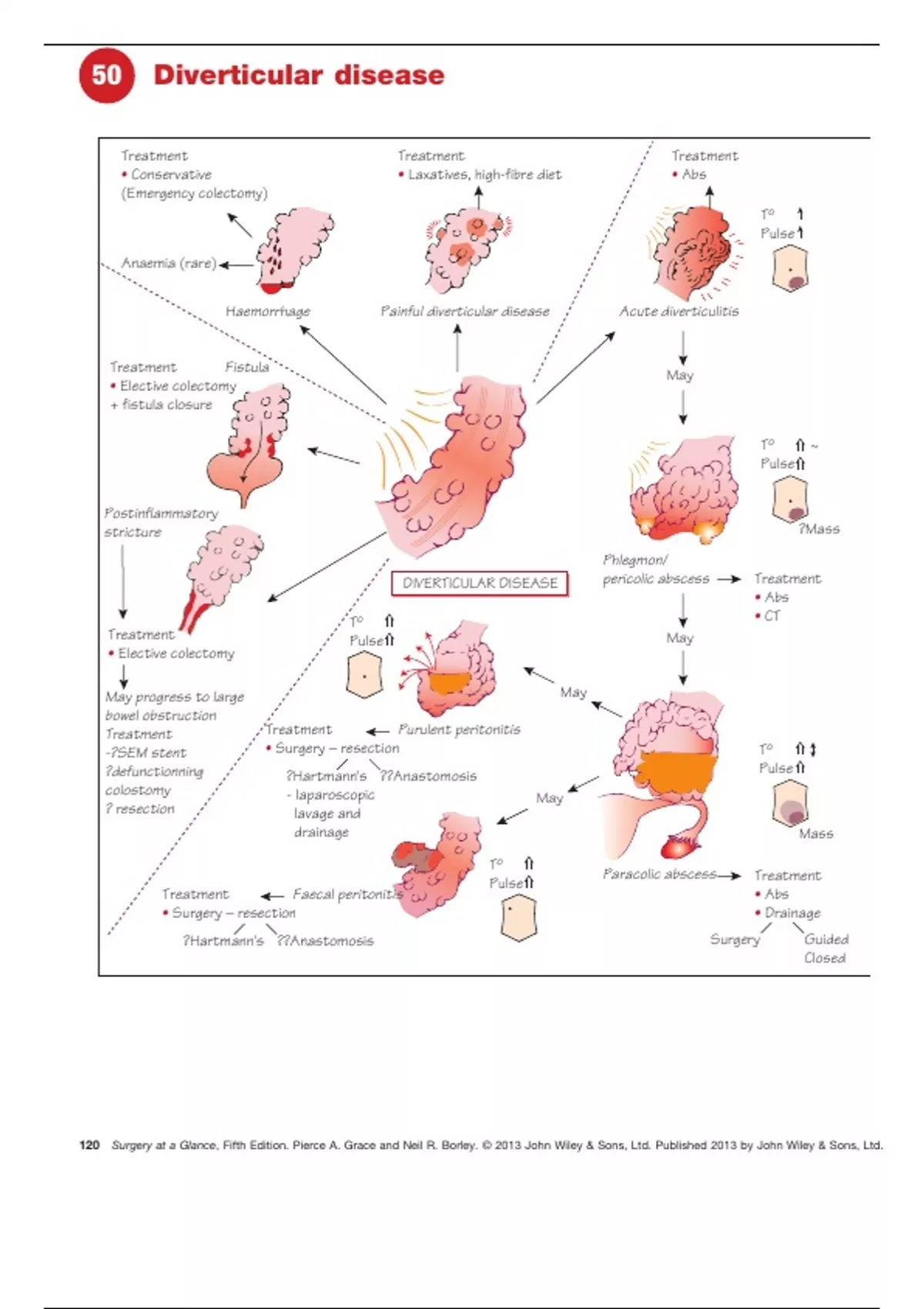 Diverticular Disease – Surgery at a Glance | Pathology, Clinical ...